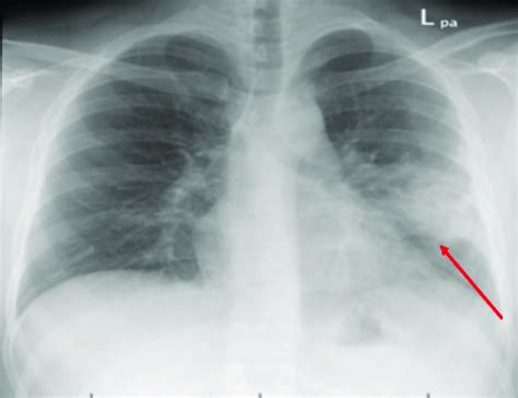 Chest X Ray Of Case One Showing Left Lung Mid Zone Opacity With Download Scientific Diagram