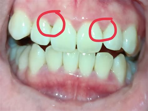 Does It Look Like I Have Periodontitis Inside The Red Circle Are They