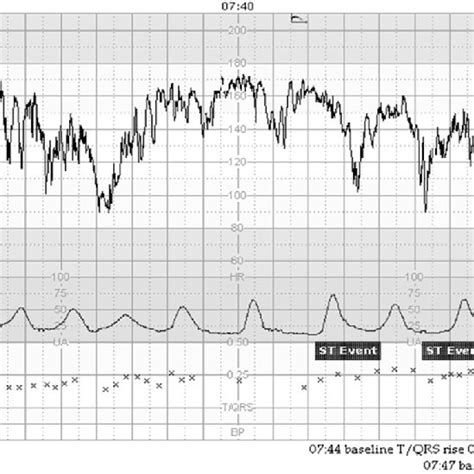 Stan ® Clinical Guidelines Classification Of Cardiotocographic Download Table
