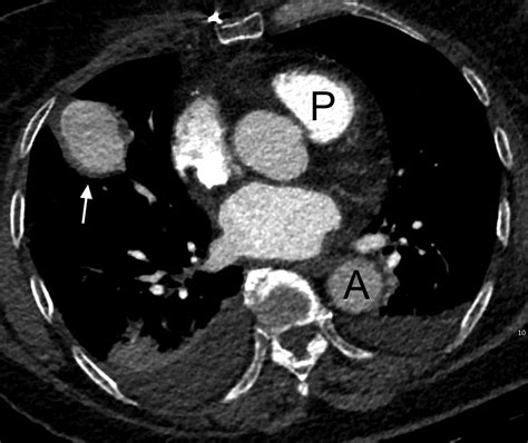 Iatrogenic Pulmonary Pseudoaneurysm Treated With Percutaneous Coil And
