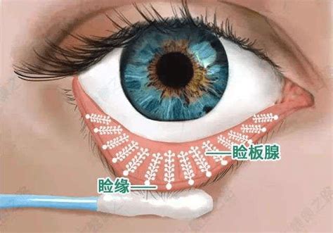 强脉冲光ipl联合睑板腺按摩治疗干眼阻塞nm 方向