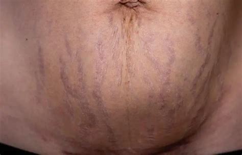 Purple Stretch Marks 6 Proven Treatments And Prevention