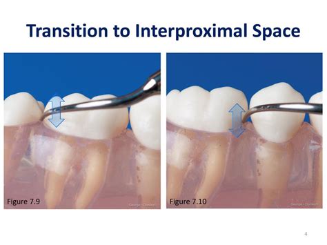 Interproximal Space Vs Embrasure At Matthew Greeves Blog