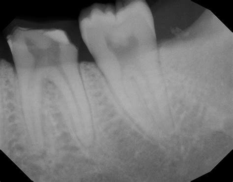 Glide Path Revisited Are Hand Files Needed In Modern Endodontic