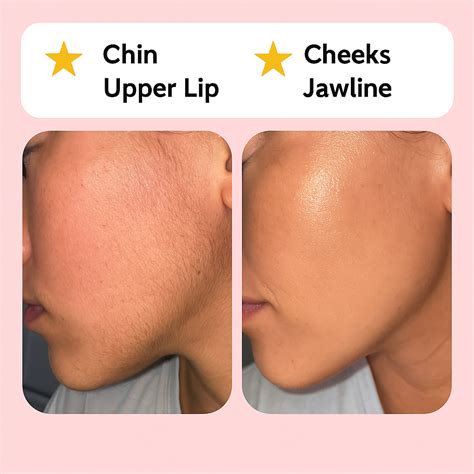 1x Epiluxe Epilator Osmo