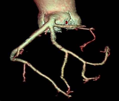 Multidetector Computed Tomography Mdct Coronary Angiography Showing