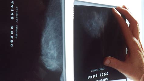 Woman Died Of Cancer After Being Cleared Twice By Breastcheck Gript