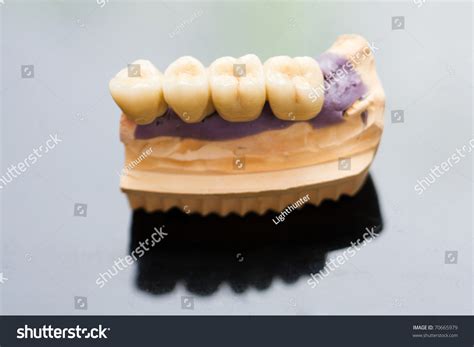 Fixed Partial Denture Dental Bridge On Foto Stock Shutterstock