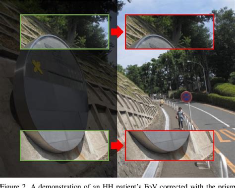 Figure 2 From Computational Alleviation Of Homonymous Visual Field
