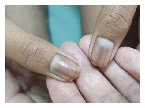 Longitudinal And Homogeneous Pigmentation On The Patients Fingernails