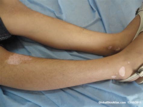 Global Skin Atlas Diagnosis Detail