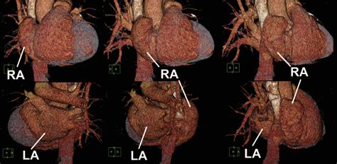 Figure 1 From Association Between Left And Right Atrial Remodeling With Atrial Fibrillation