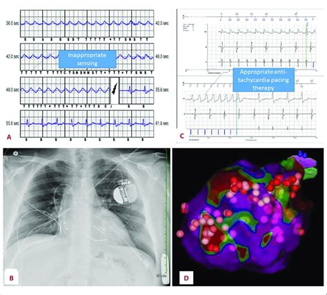 A Subcutaneous Implantable Cardioverter Defibrillator S Icd Download Scientific Diagram