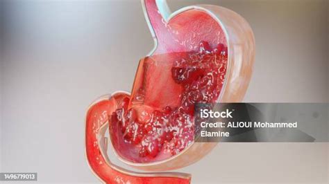 위암 소화 시스템의 종양 성장 소화성 궤양 암 공격 세포 위 질환 개념입니다 증상 악성 암 바이러스 및 박테리아 단면 3d 렌더링 건강관리와 의술에 대한 스톡 사진 및 기타
