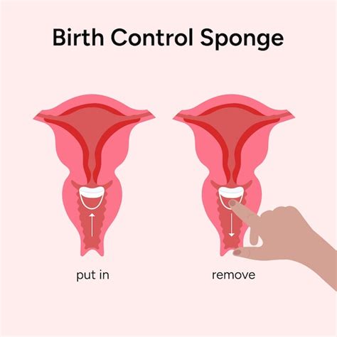 Premium Vector Birth Control Sponge Illustrations In Vector
