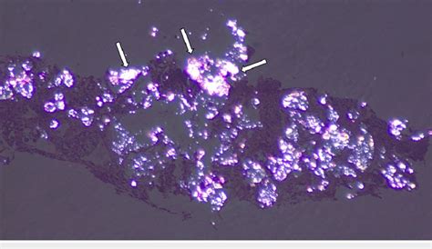 Biopsy On Polarising Microscopy Appears Birefringent White Arrows Download Scientific Diagram