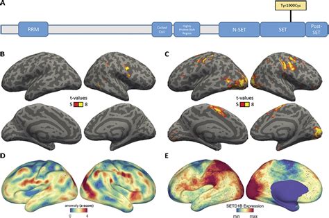Connectome Analysis In An Individual With Setd1b Related Neu