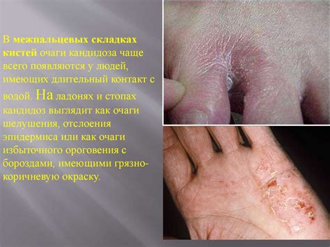 Кандидоз Причины кандидоза Online Presentation