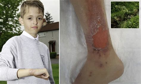 Stinging Nettle Blisters