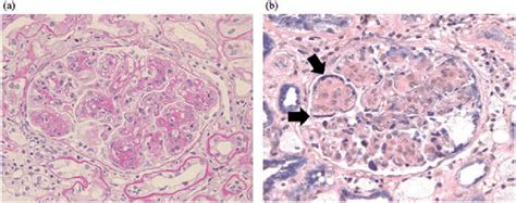 Light Microscopic Findings Of The First Biopsy A A Glomerulus