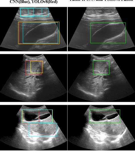Gallbladder Cancer Detection In Ultrasound Images Based On Yolo And