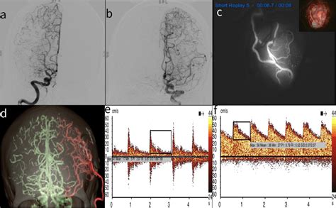 Representative Case A 39 Year Old Women Who Underwent Left Sta Mca Download Scientific Diagram