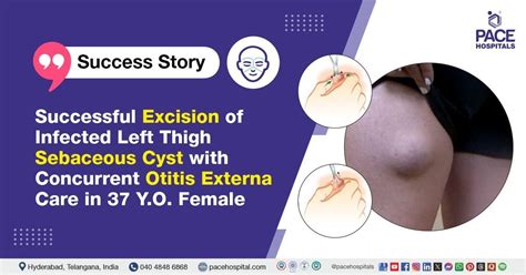 Thigh Sebaceous Cyst Treated With Incision And Drainage Excision