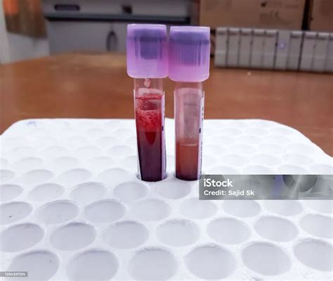Blood Sample Vial With Whole Blood In A Edta Lavender Vial For