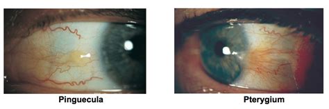 Differences Pinguecula Vs Pterygium Oasiseye Specialists