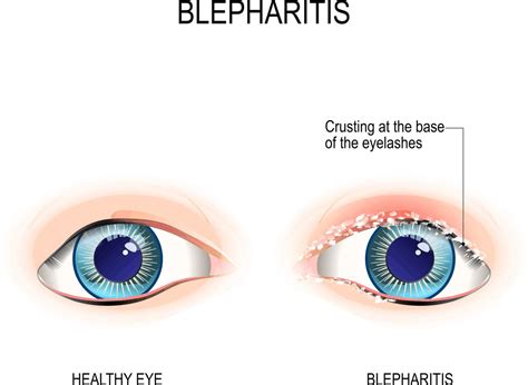 Difference Between Dry Eyes Blepharitis And Mgd Get Solutions Dry Eye Masks Store