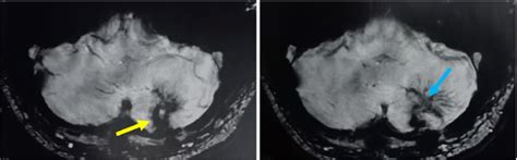Postoperative Mri Yellow Arrow Shows No Recidive Of Cavernoma Blue