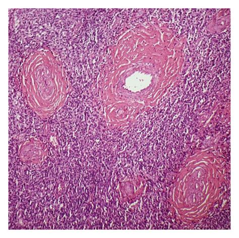 Tissue Showing Hyalinized Blood Vessels Hande Stain ×100 Download