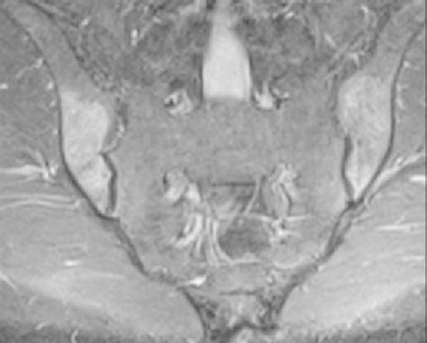 bone marrow edema of the sacroiliac joints with active sacroiliitis download scientific diagram
