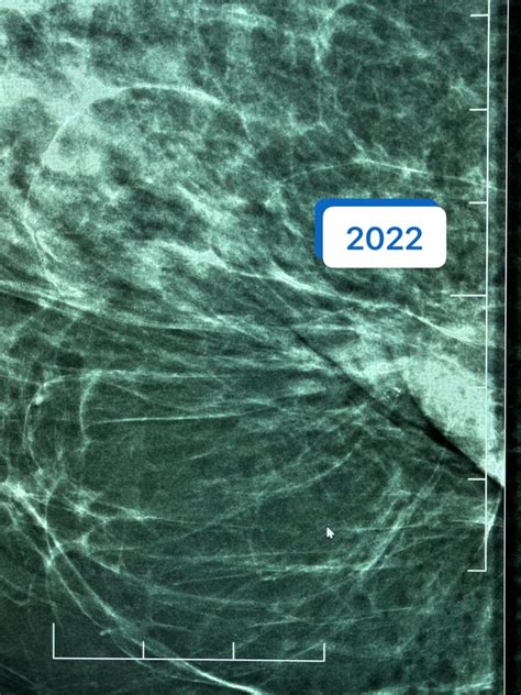 This Patient In 2022 Had Evidence Of Grouped Pleomorphic Calcifications