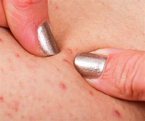 What Is Folliculitis Prevention And Treatment