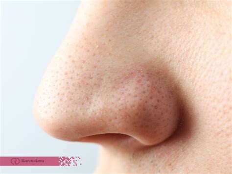 Comedonal Acne What Causes And Treatmeent Remotederm
