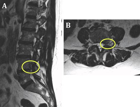 The Minimally Invasive Paramedian Approach For Foraminal Disc