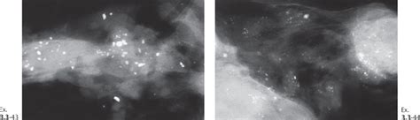 Multiple Clusters Of Crushed Stone Like Calcifications On The Mammogram Produced By Malignant