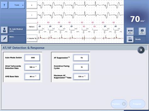 PPT AF Suppression PowerPoint Presentation Free Download ID