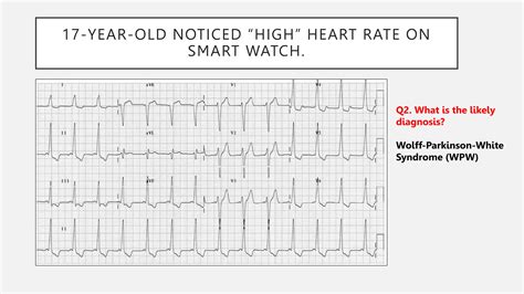 Lethal Ecg Pattern Reading And Diagnosis Pptx