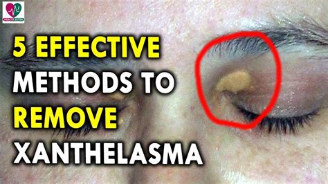 Xanthelasma Removal What Is Xanthelasma And How Is It Treated Ovgtk