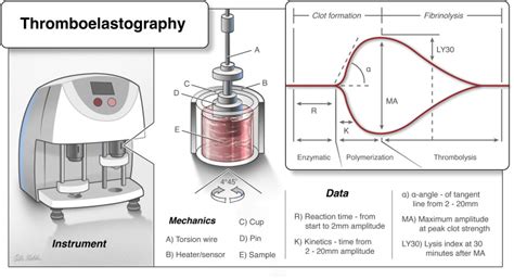 Clinical Use And Interpretation Of Thromboelastography Pmc