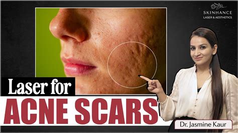 How To Get Rid Of Acne Scars Acne Scar Treatment Lasers For Acne Scars Skinhance Clinic