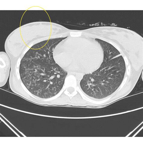 Ct Chest Image Demonstrates Multiple Tree In Bud Opacities Within The