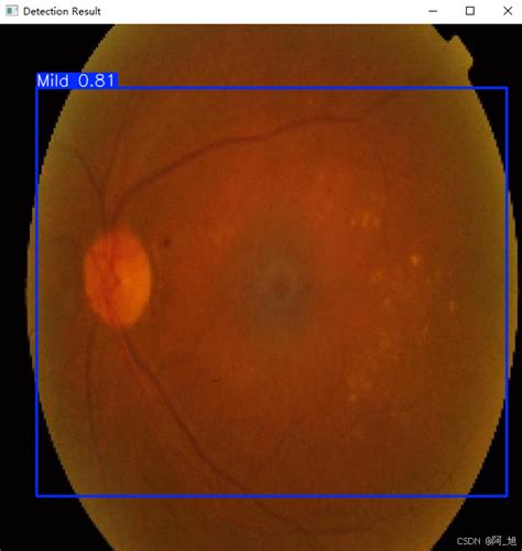 基于yolo11深度学习的糖尿病视网膜病变检测与诊断系统【python源码pyqt5界面数据集训练代码】视网膜病变检测 Yolo Csdn博客