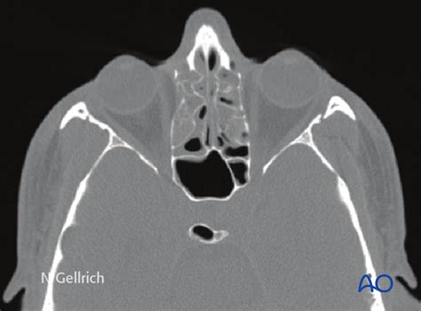 Le Fort Fracture X Ray How To Simplify The Ct Diagnosis Of Le Fort
