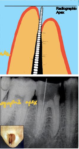 Electronic Apex Locators Flashcards Quizlet