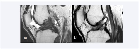 Anterior Cruciate Ligament Tear Mri