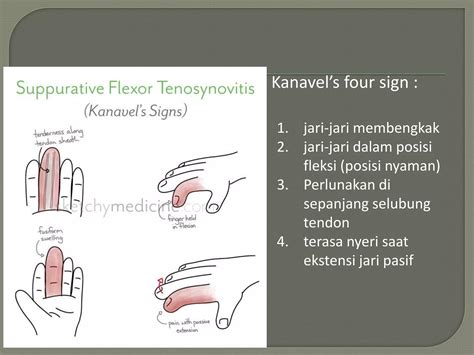 Tenosynovitis Supuratif Pptx