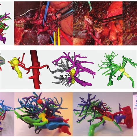 Bismuth Iv Type Perihilar Cholangiocarcinoma With Right And Left Portal